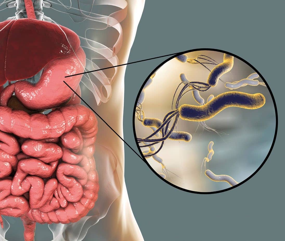 The Cancer Causing Stomach Bug