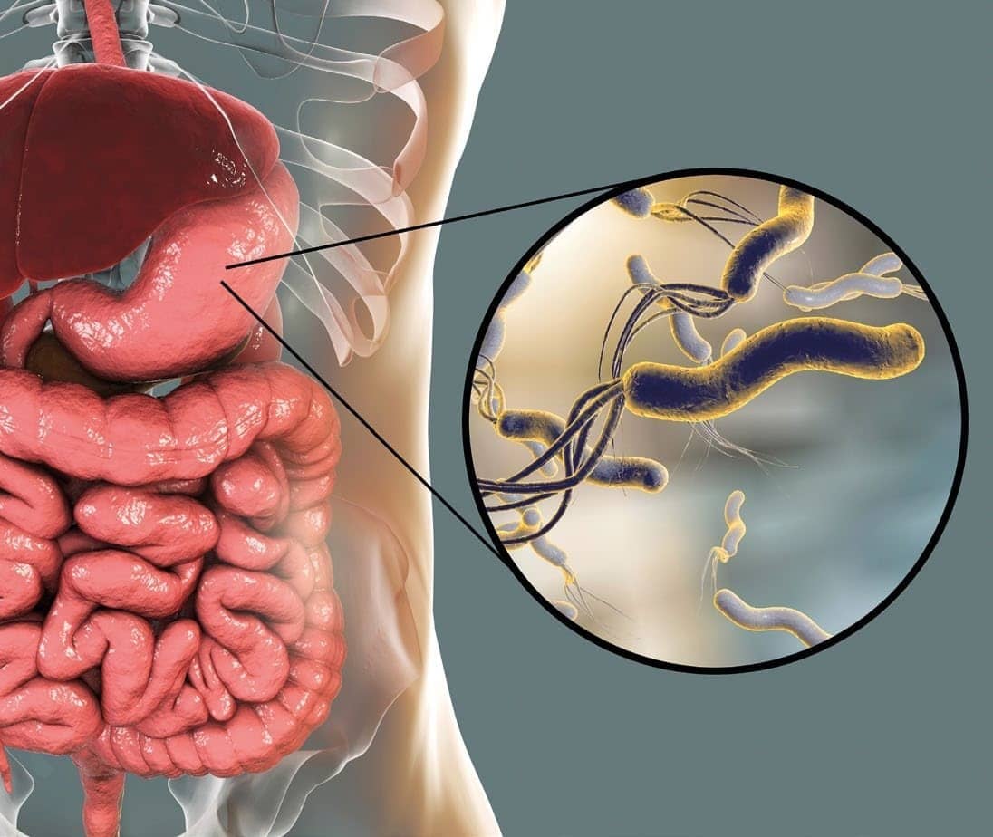 The Cancer Causing Stomach Bug